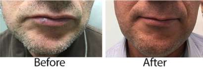 Venous Lake Treatment | Spots, dots and bumps on the lip | Mclean ...