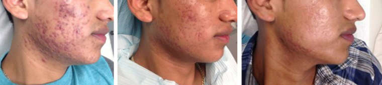 Acne Scar Treatments | McLean & Woodbridge Virginia | Skin & Laser ...