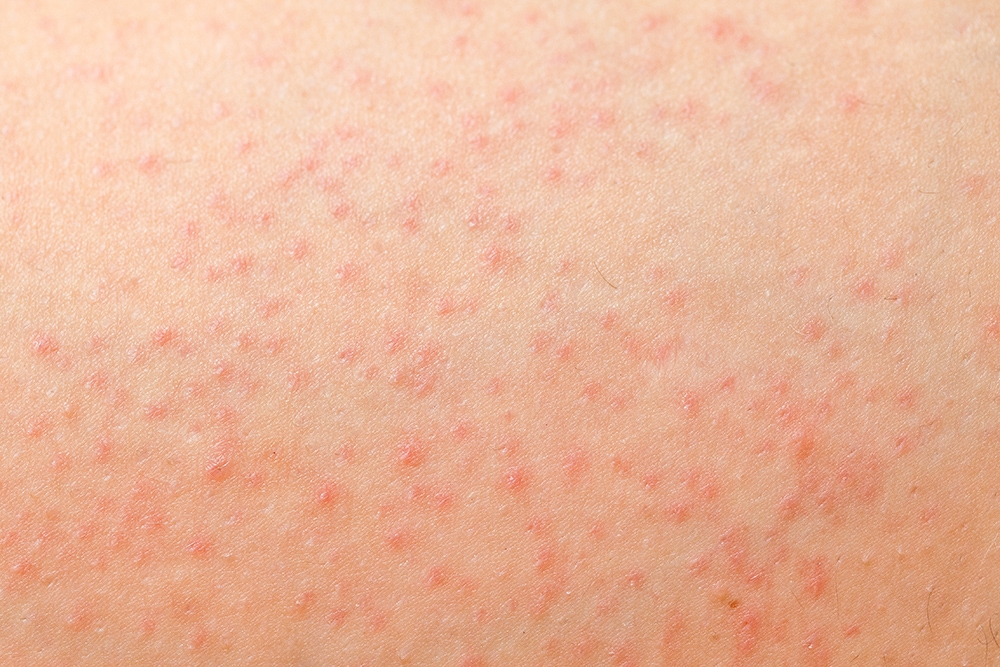 Folliculitis Thighs Folliculitis Thighs