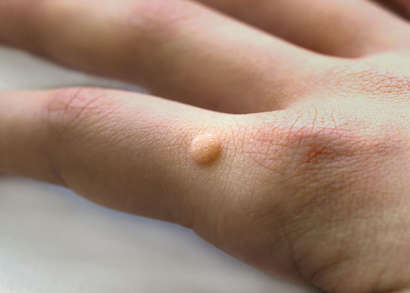 Common Warts (Verruca Vulgaris) | Mclean VA & Woodbridge, VA | Skin ...