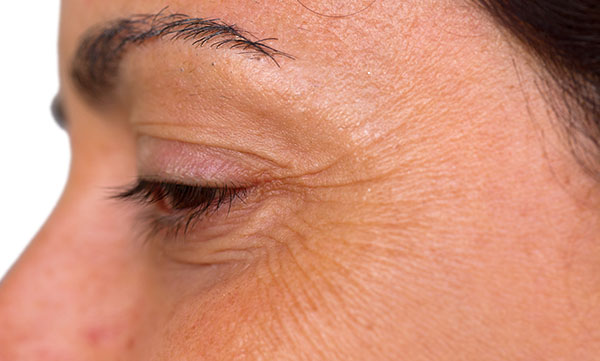 Crow’s Feet Lines | Mclean VA & Woodbridge, VA | Skin & Laser ...