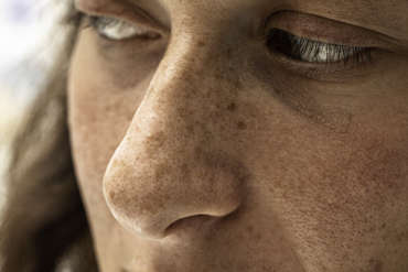 Sun Freckles (ephelides) | Mclean VA & Woodbridge, VA | Skin & Laser ...