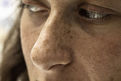 Sun Freckles (ephelides) | Mclean VA & Woodbridge, VA | Skin & Laser ...